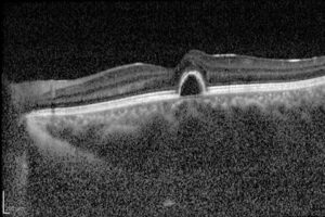 Macular Pucker Seattle | Comprehensive Eye Care Issaquah, WA