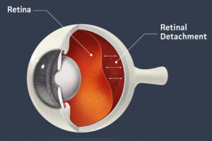 Retinal Detachment Issaquah | Retina Specialist Seattle, WA